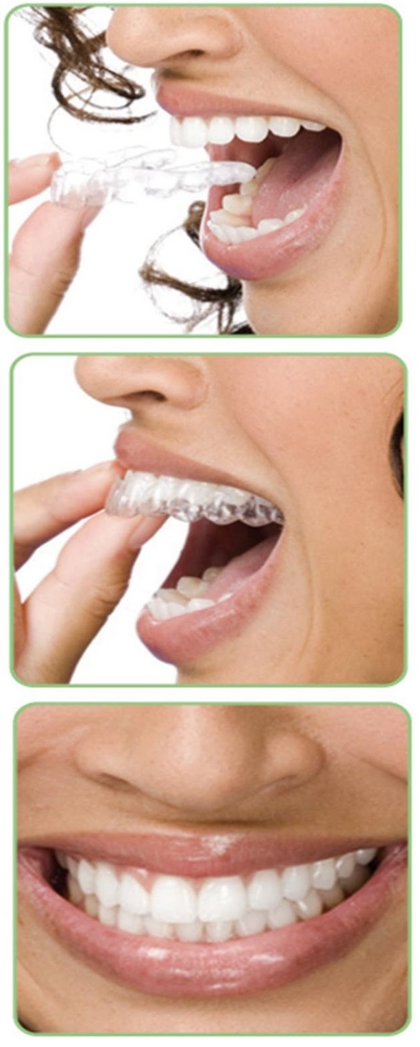 Teeth Straightening ClearCorrect Clear Aligners in San Antonio ...